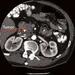 Computed Axial Tomography (CAT or CT) Scan – Pancreatic Cancer Action ...